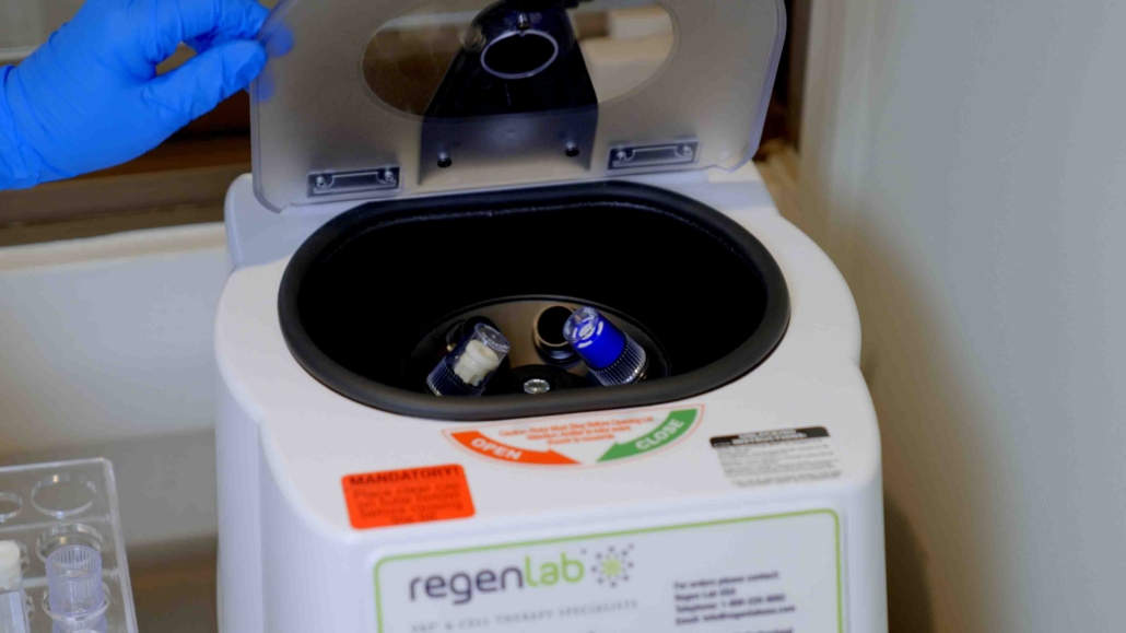 PRP (Platelet Rich Plasma)